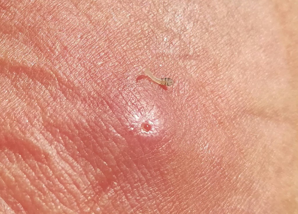 Human Botfly from Pastaza, EC-PA, EC on October 12, 2018 at 06:07 PM by ...